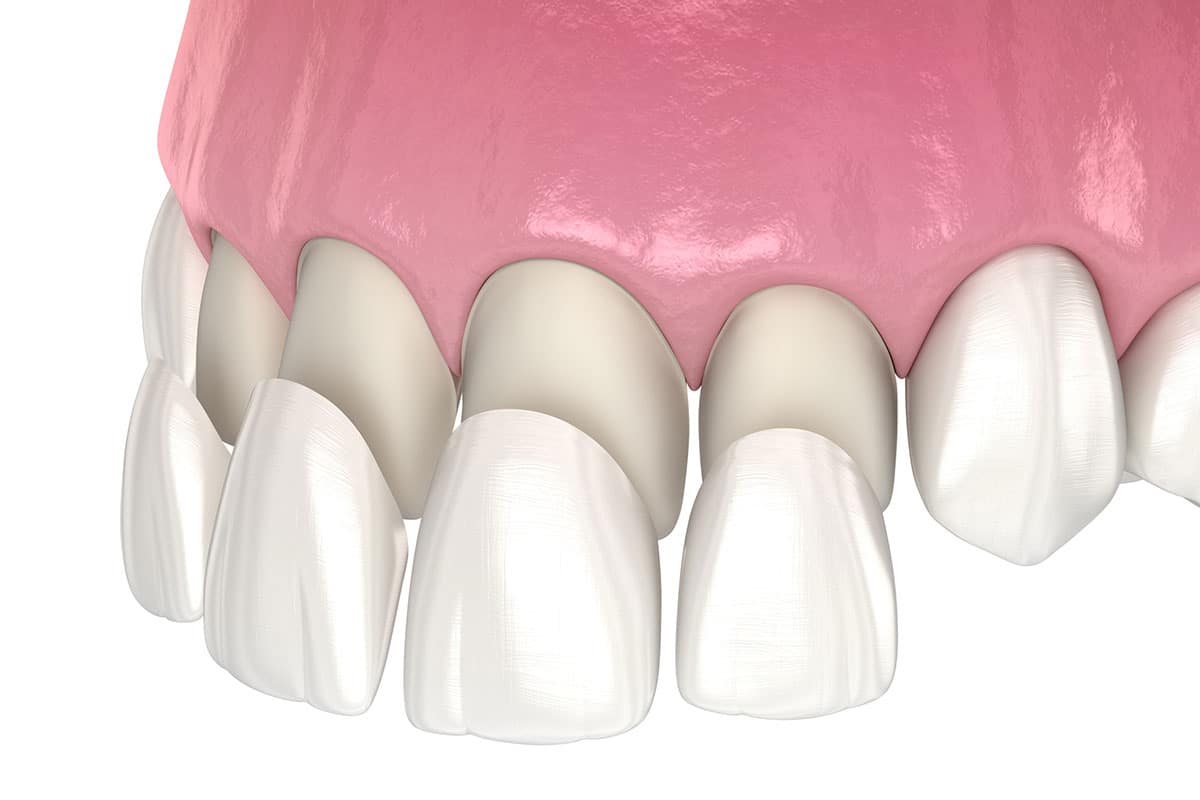 How Long Do Dental Veneers Last? - R Renan Williams, DDS