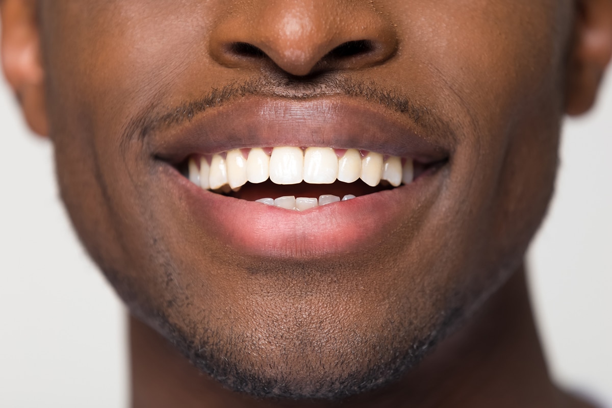 How Long Does Professional Teeth Whitening Last? - R Renan Williams, DDS