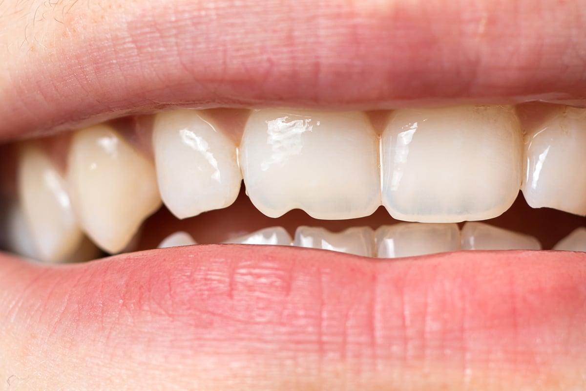 What to Do If You Chip or Break a Tooth Over the Weekend - R Renan ...